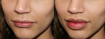 Fat Transfer to Lips Before and After - Dr.Meysam Zarghami